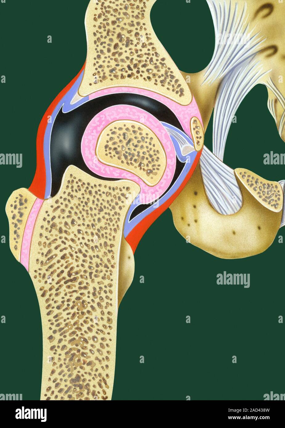 Slipped capital femoral epiphysis. Illustration of a frontal section ...