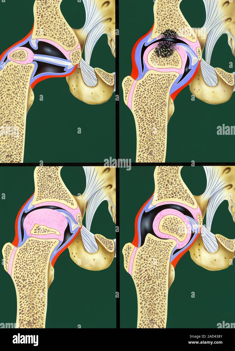 Childhood hip disorders. Set of four illustration of frontal sections ...