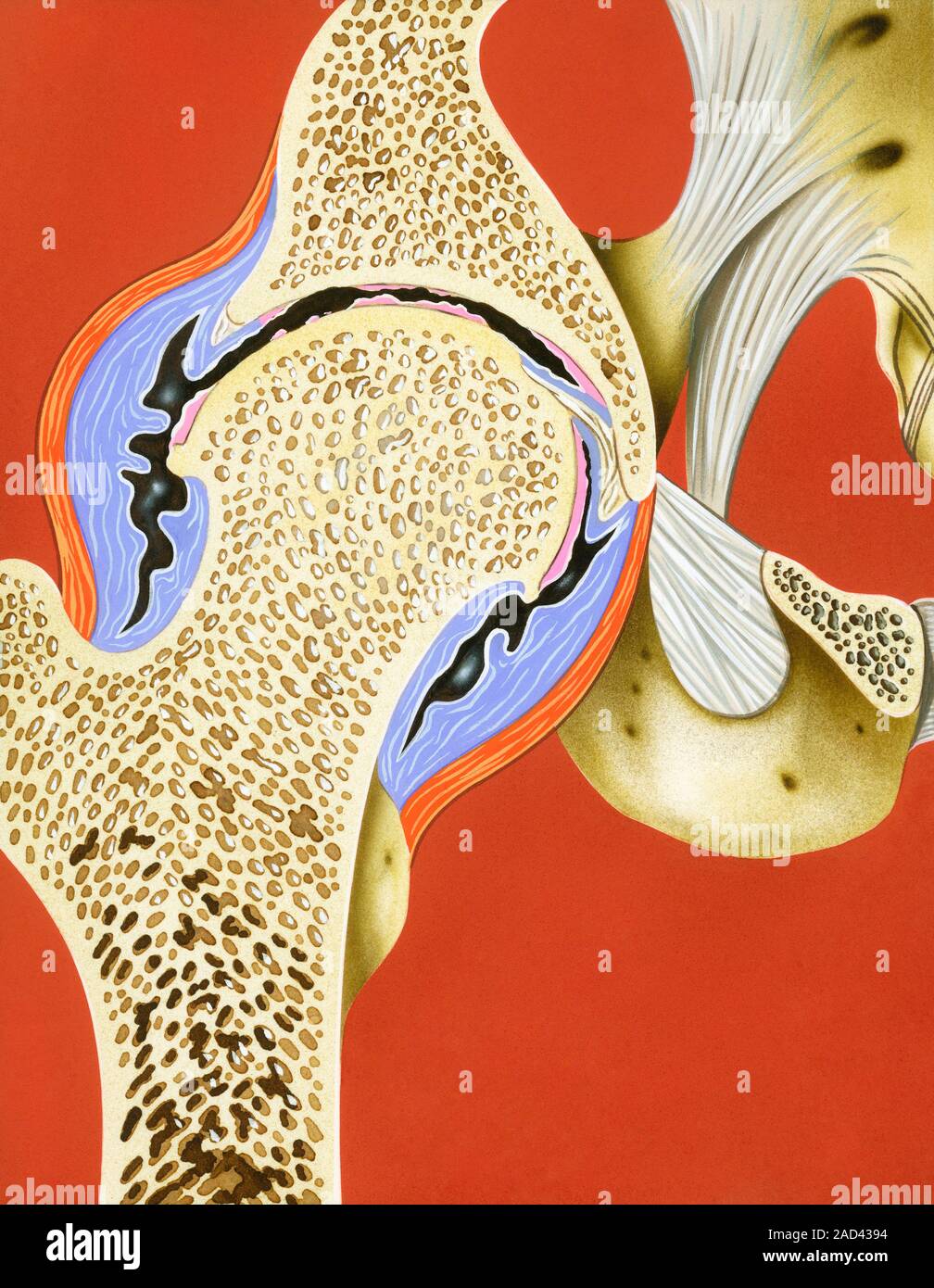 Hip joint inflammation. Illustration showing the inflammation of the ...