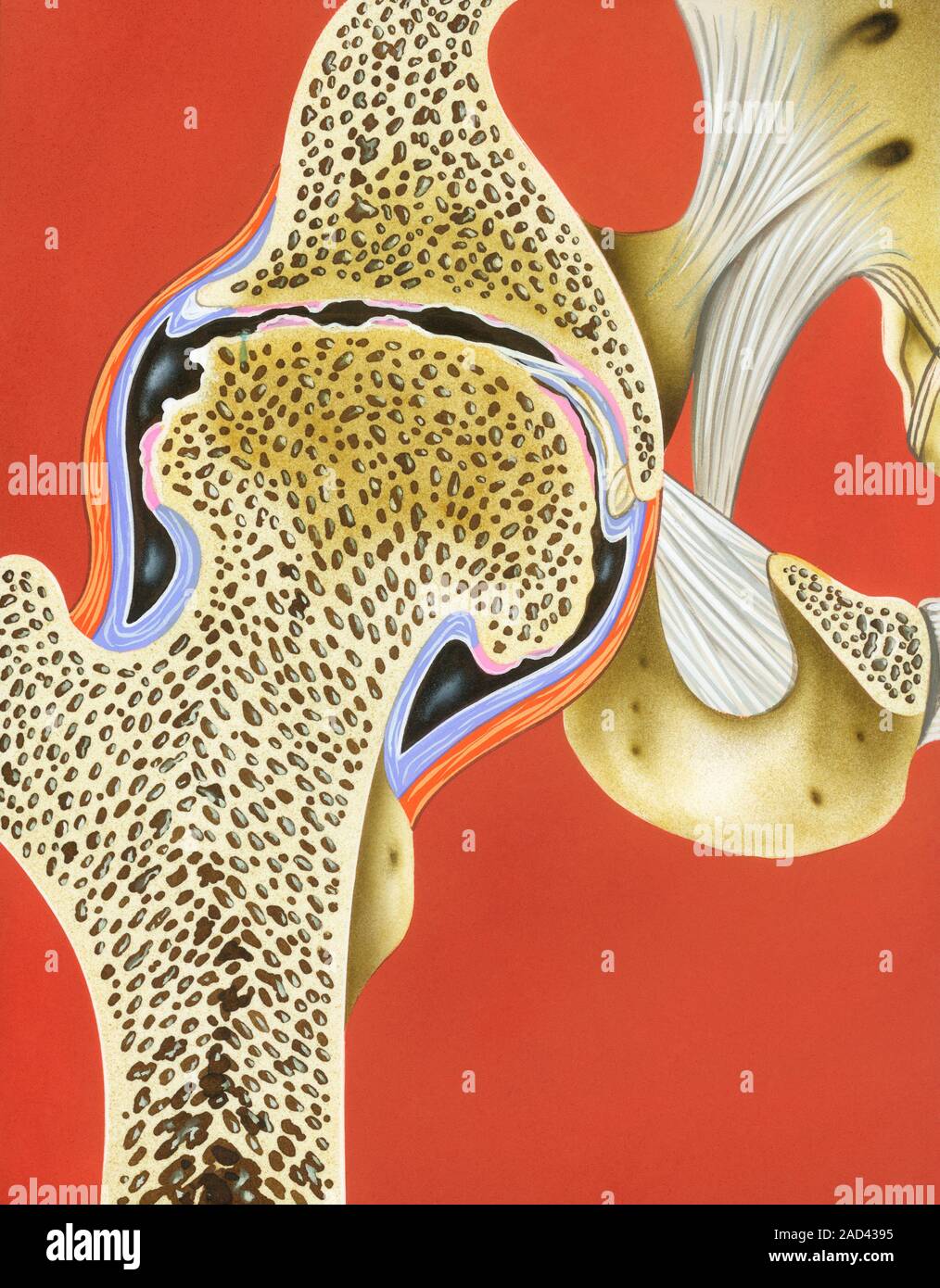 Hip joint pannus formation. Illustration showing pannus formation ...