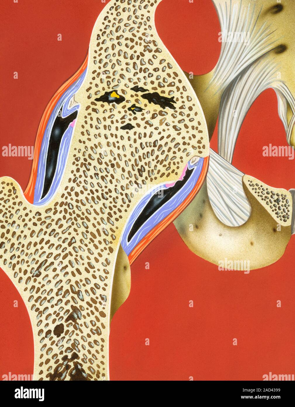 Hip joint bony ankylosis. Illustration showing bony ankylosis (fusing ...