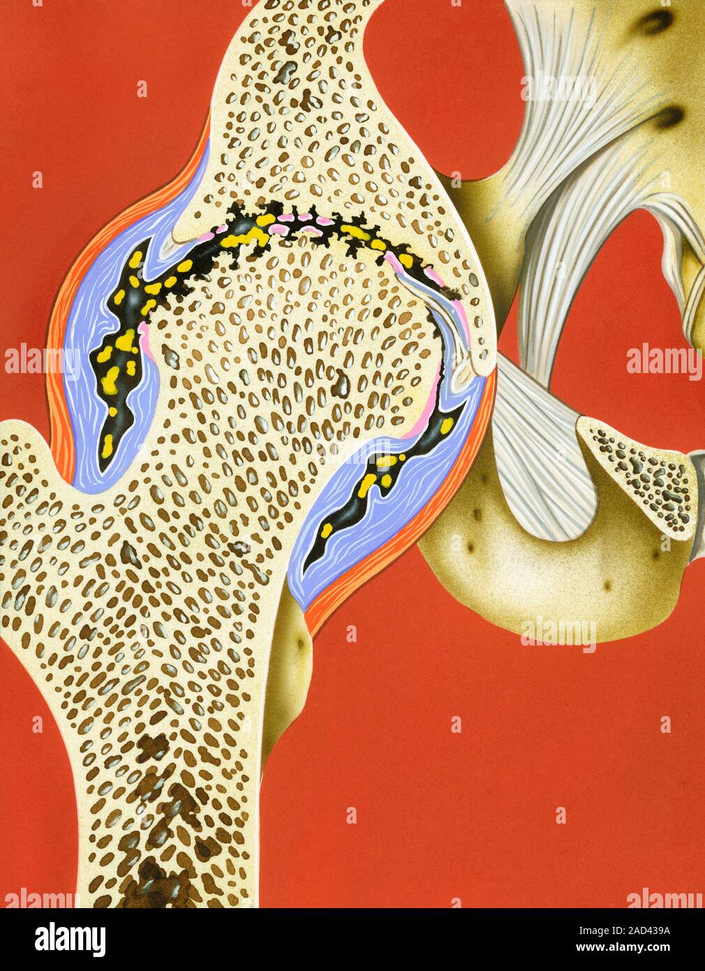 Hip joint cartilage loss. Illustration showing the destruction and loss ...