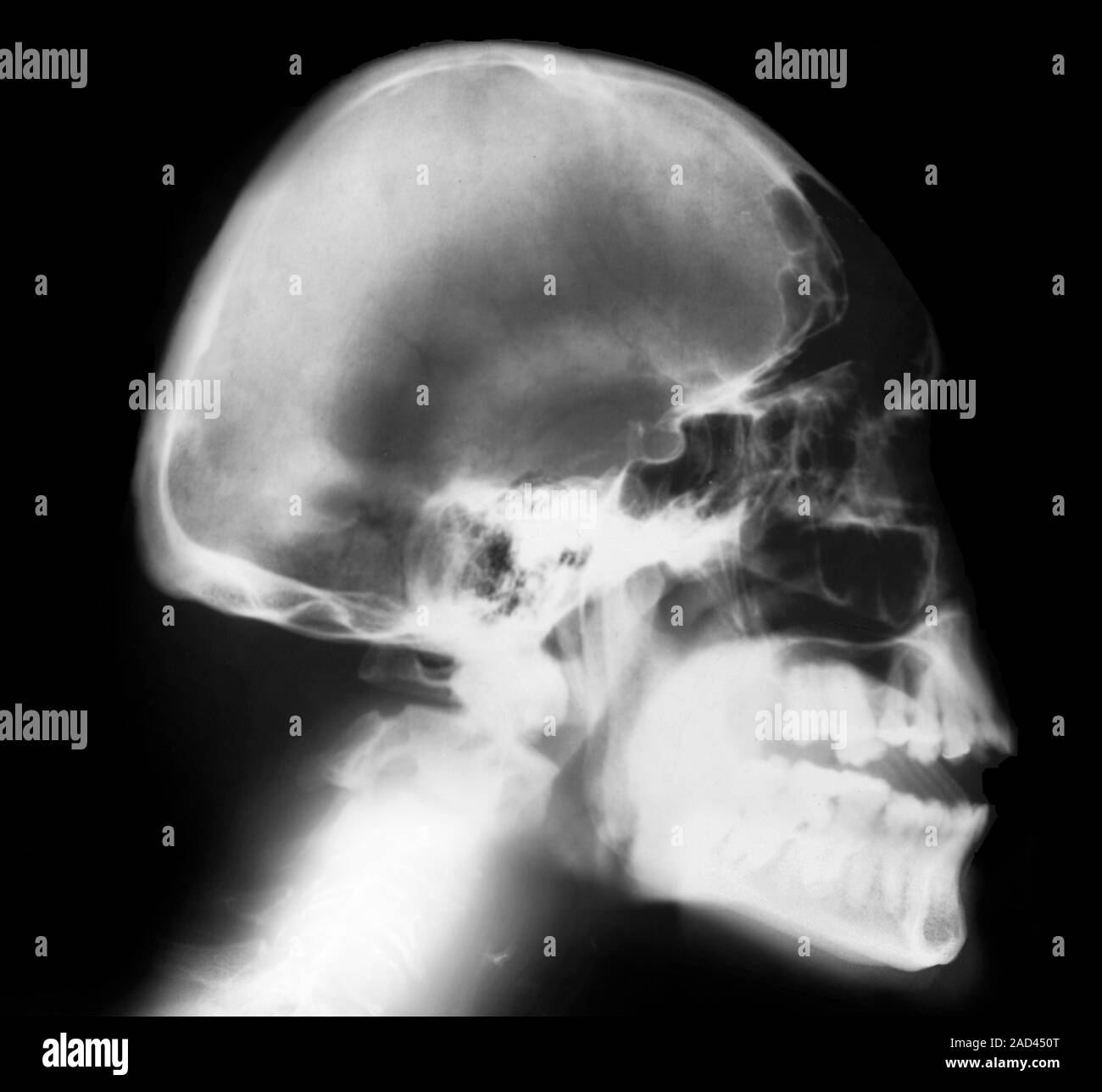 Microcephaly. Lateral X-ray (side view) of the head and skull of a 23 ...