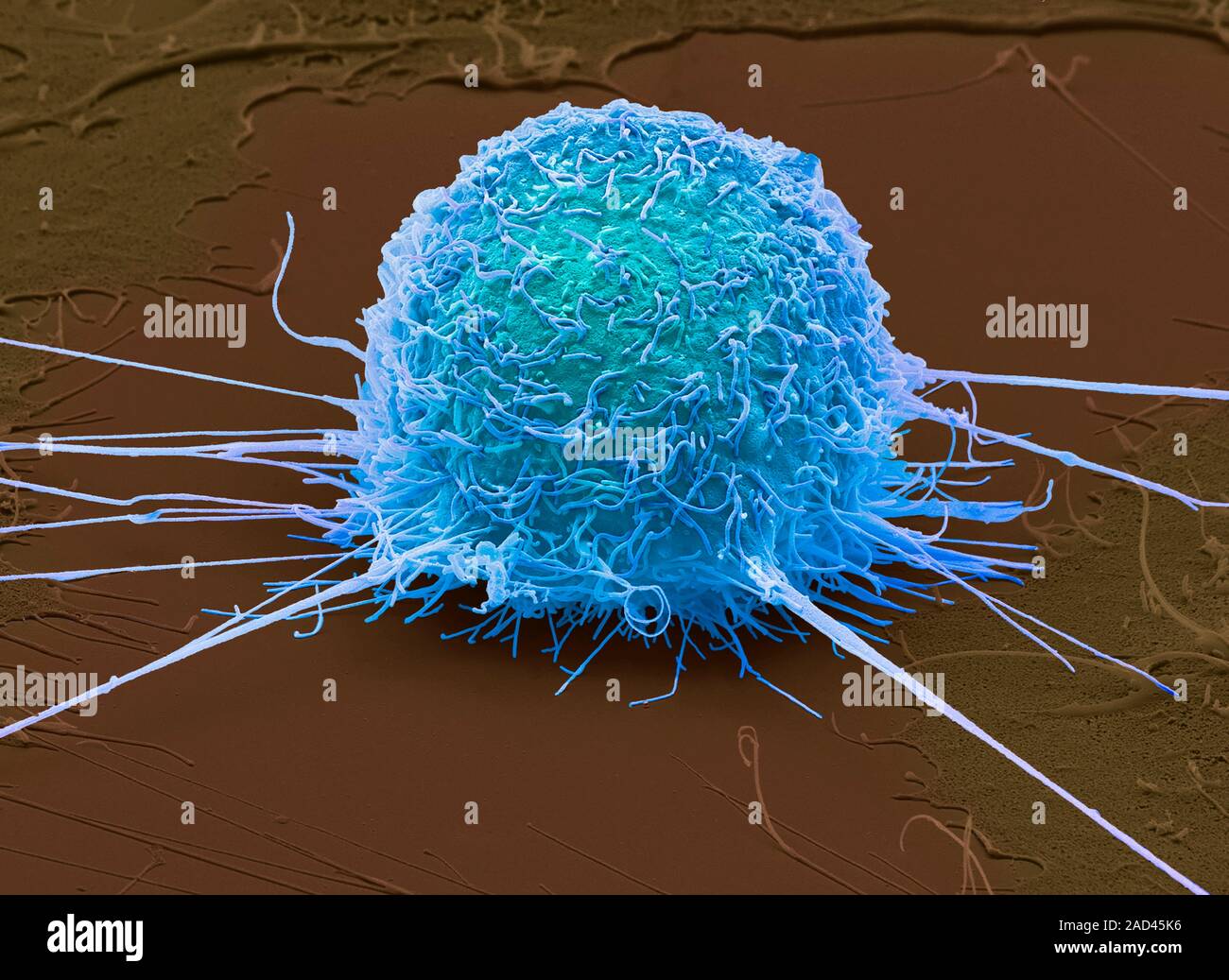 Mouth cancer cell. Coloured scanning electron micrograph (SEM) of a ...