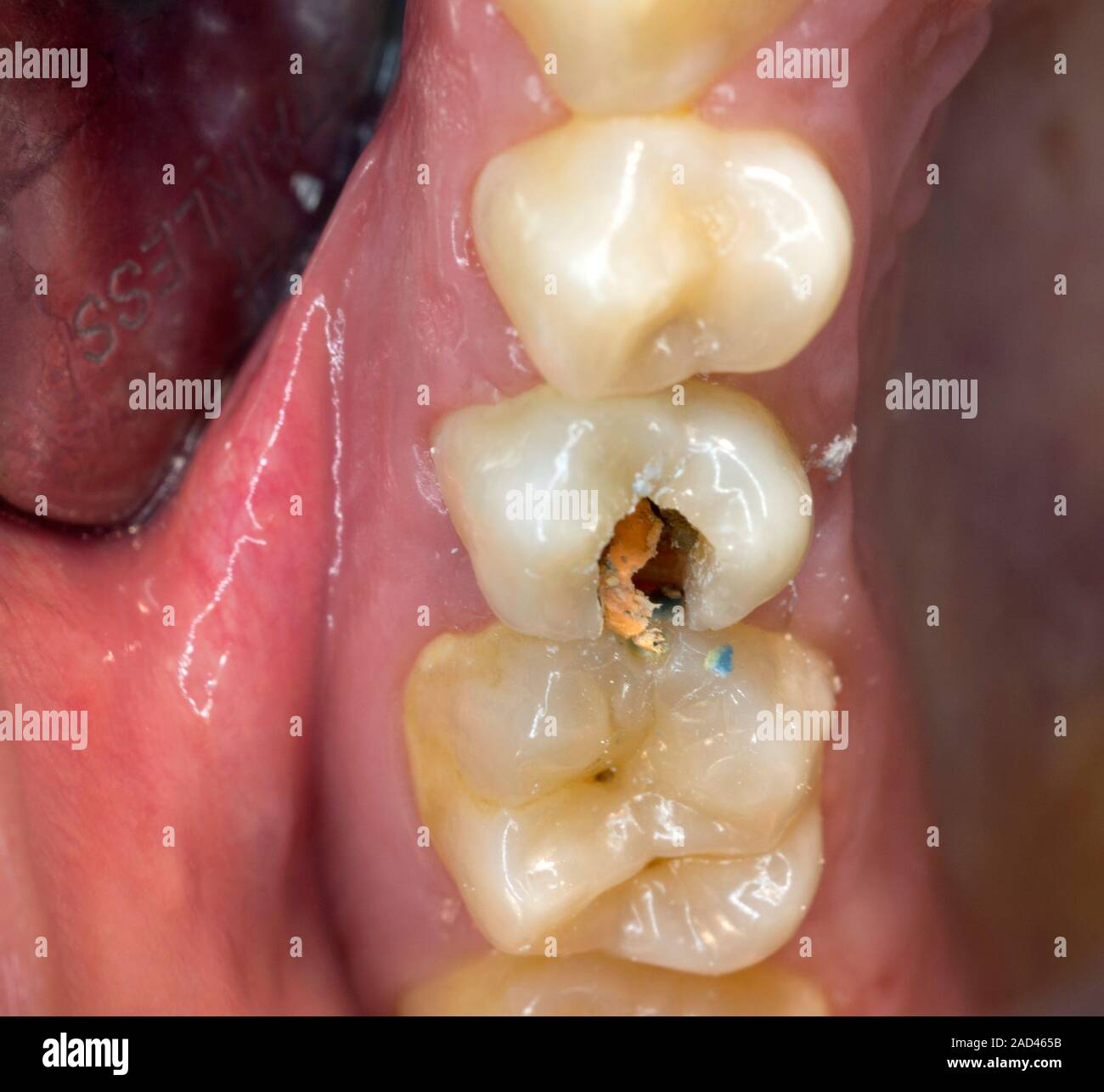 Dental caries. Close up of a decay cavity in a premolar tooth. The ...