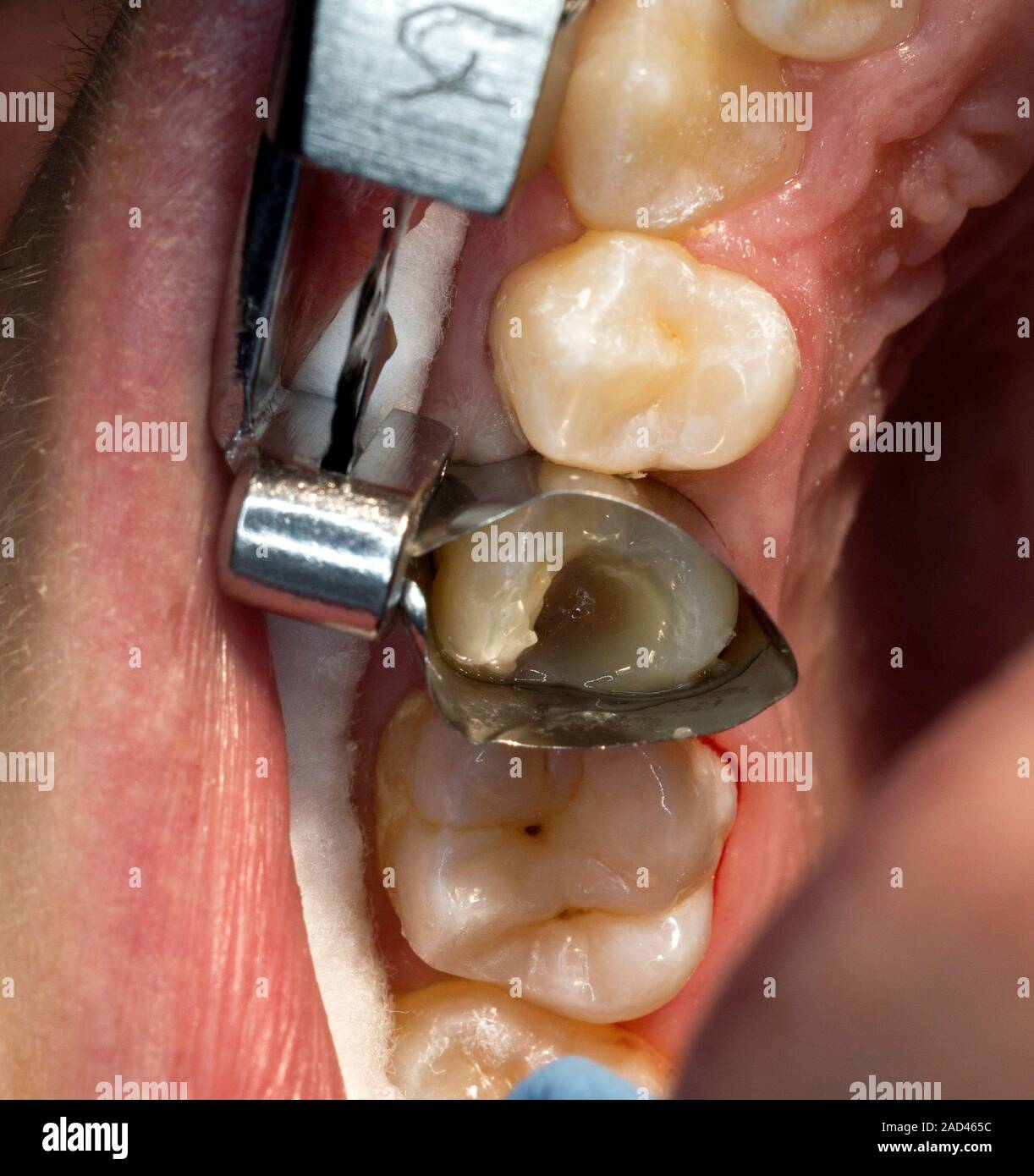 Dental filling. A matrix holder is placed around the decayed premolar ...