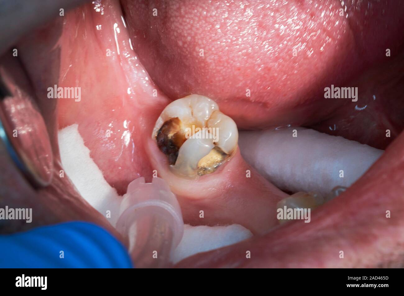 Dental caries. Close up of dental caries in a lower molar tooth. The ...