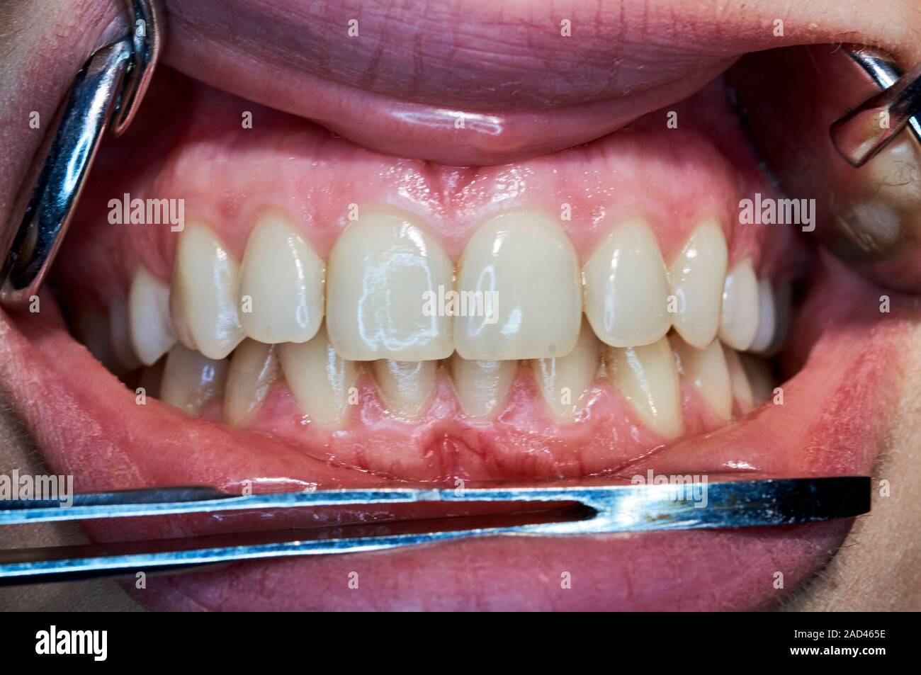 Healthy teeth. Healthy adult teeth of the upper and lower jaw, with ...