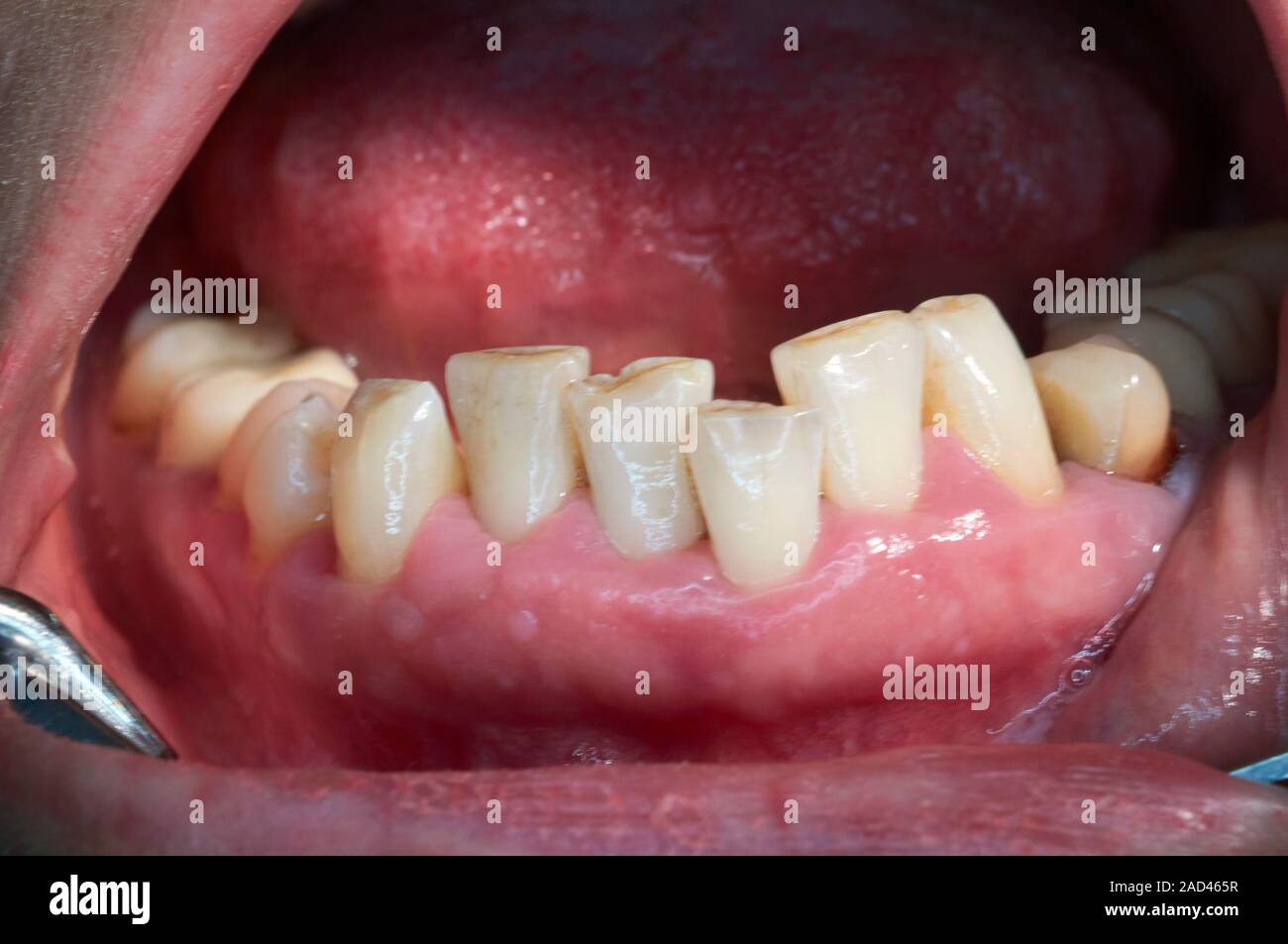 Crowded teeth. Close-up showing crowding of teeth, when there is ...