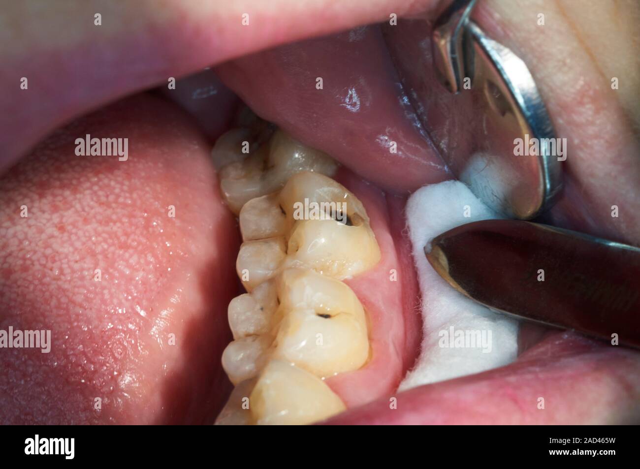 Dental caries. Close up of dental caries (blackened cavity) in a lower ...