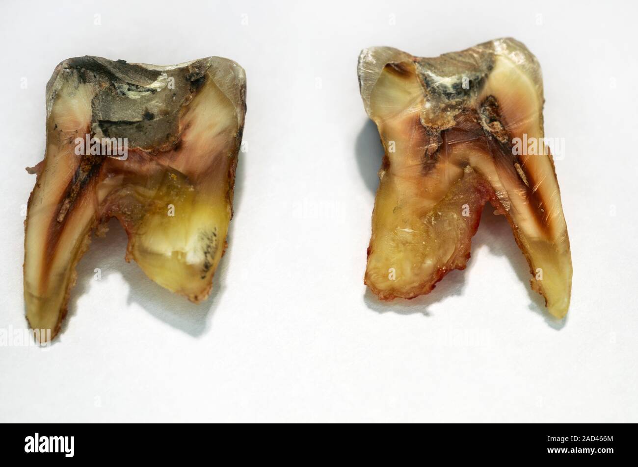 Tooth structure. An extracted tooth cut in half to show its structure ...