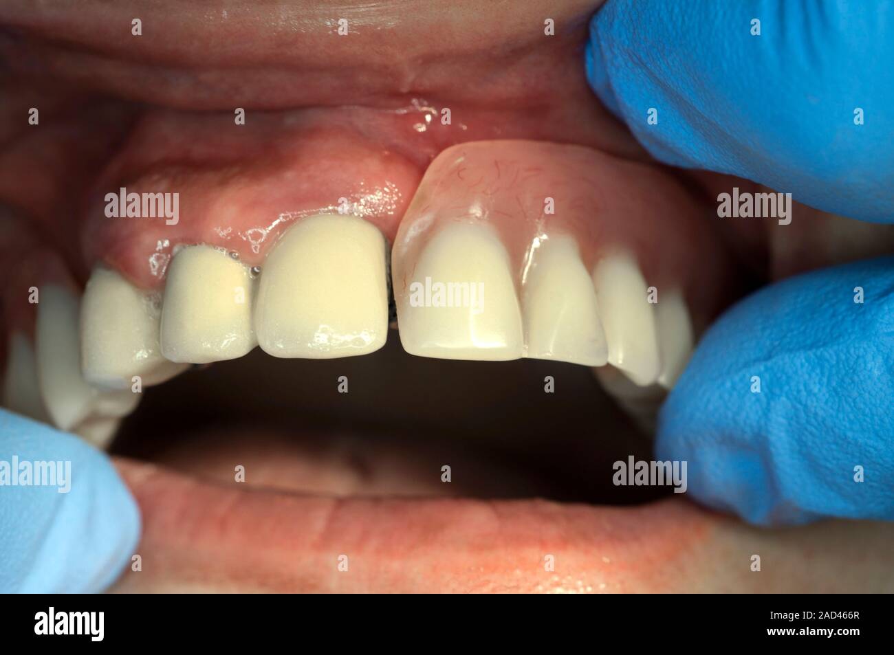 Dental bridge and denture. A patient's existing teeth have been capped ...