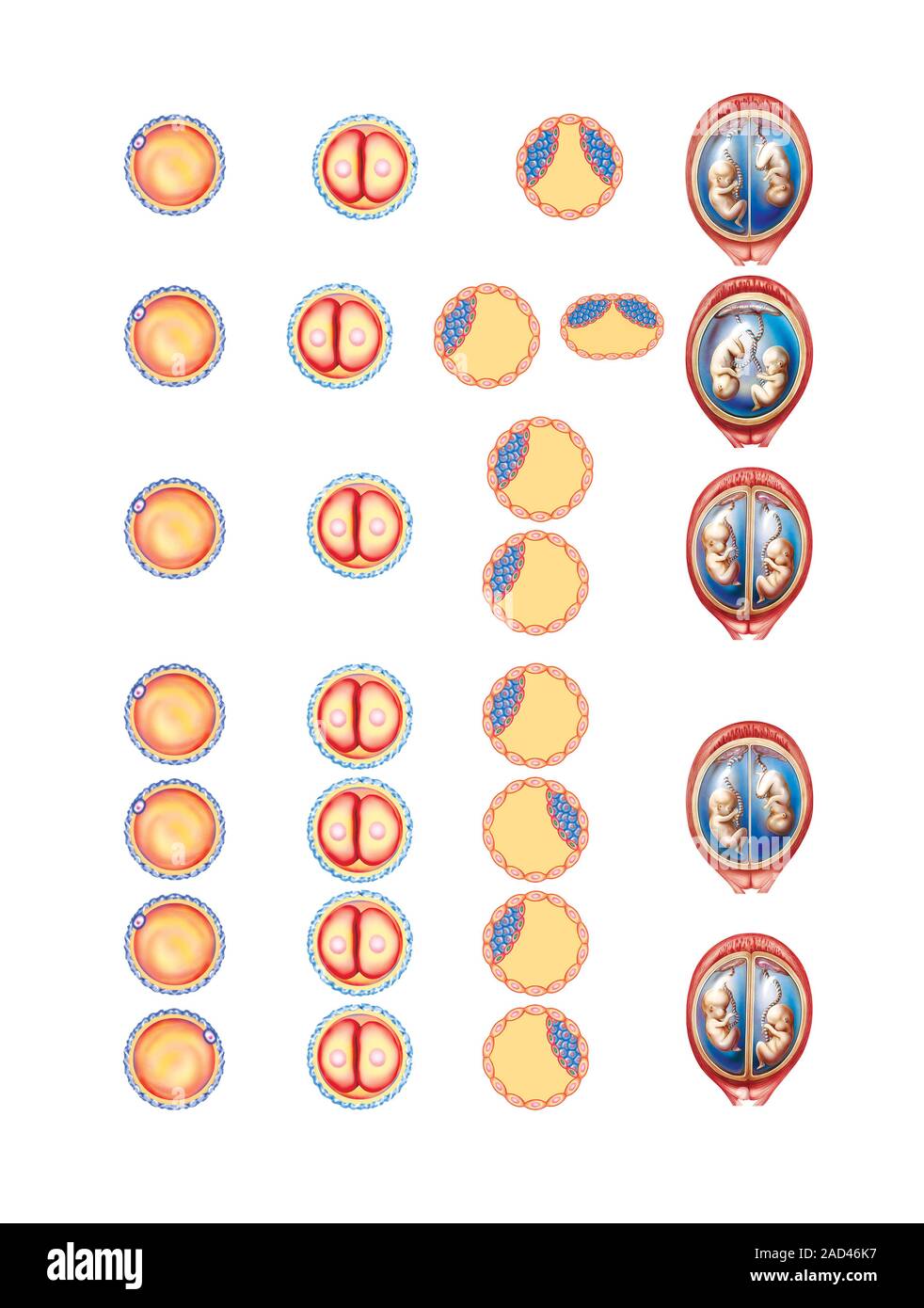 Illustration of the possible types of twin pregnancies. This ...
