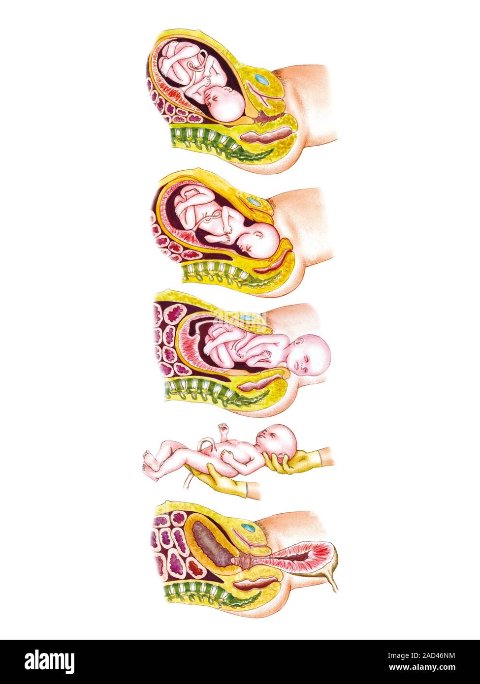 Illustration of childbirth. Stages of Labor. This illustration is from ...