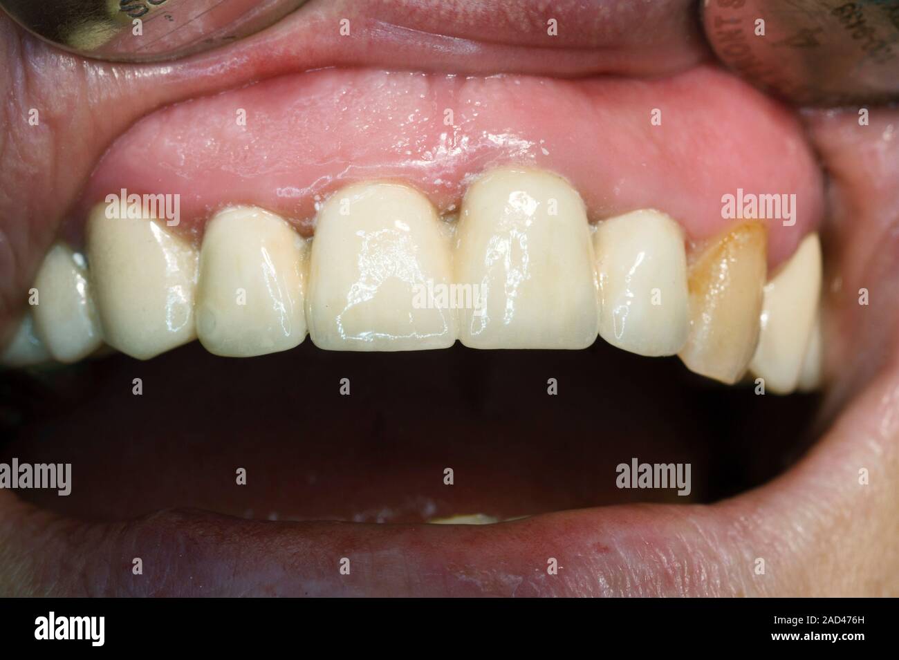 Dental crowns. Close-up of the upper incisor teeth (front 4 teeth) of a ...