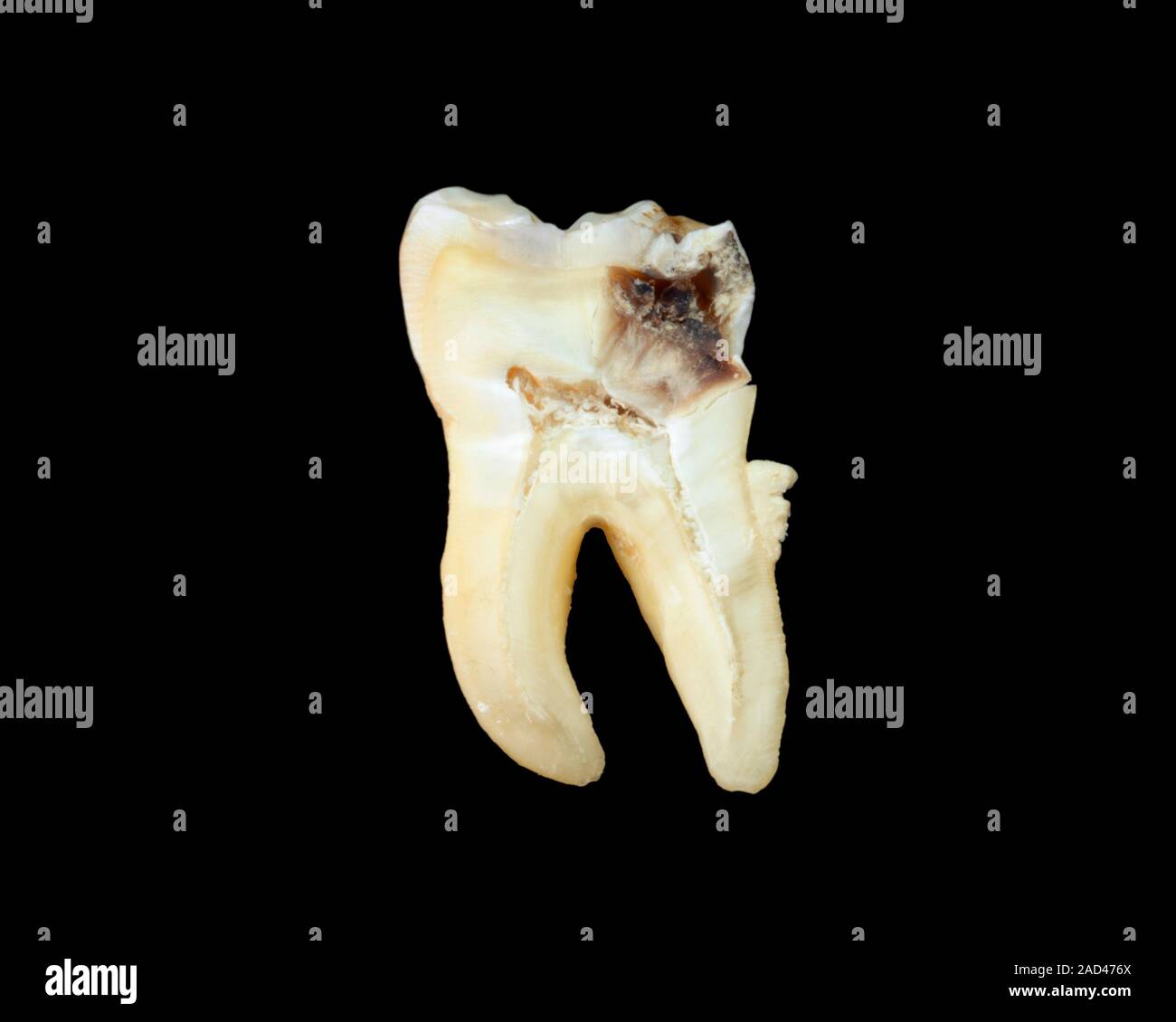Decayed tooth structure. An extracted molar tooth sectioned to show the ...