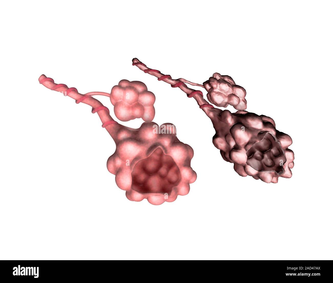 Normal and emphysemic alveoli. Computer illustration comparing healthy ...