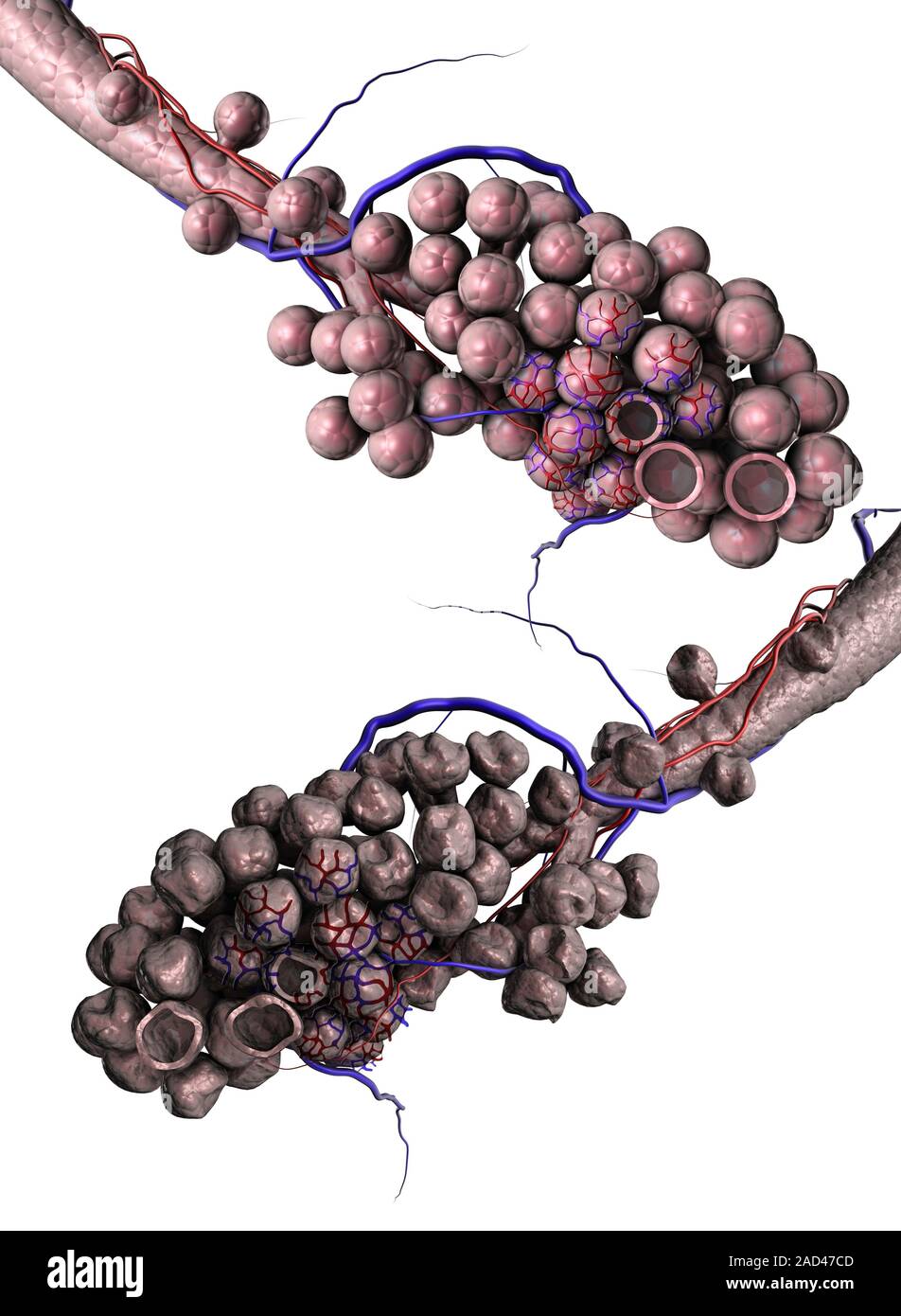Normal and emphysemic alveoli. Computer illustration comparing healthy ...