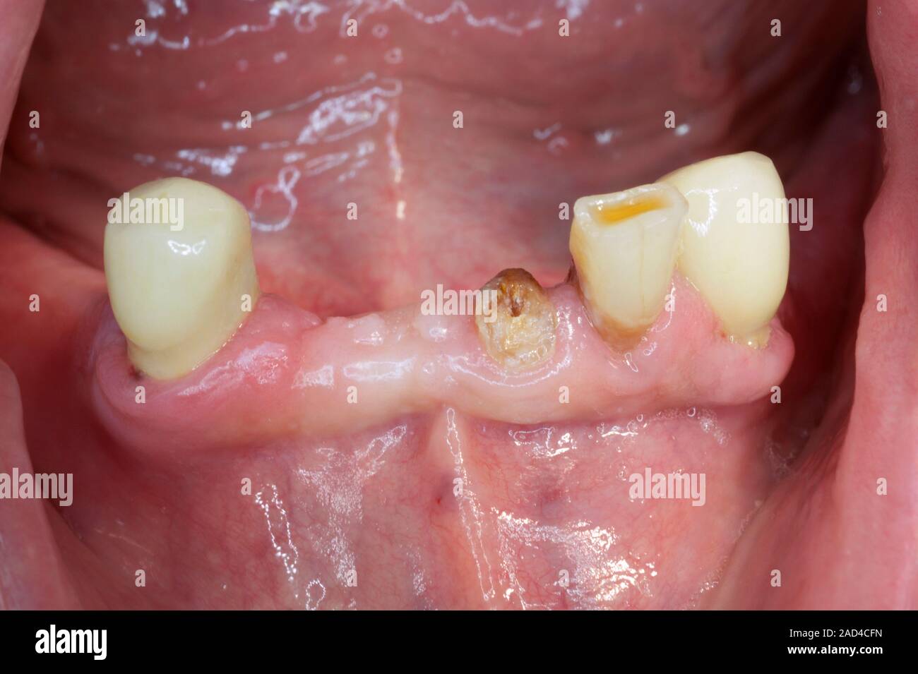 Tooth root. Close up of the root of a lower incisor tooth. The crown ...