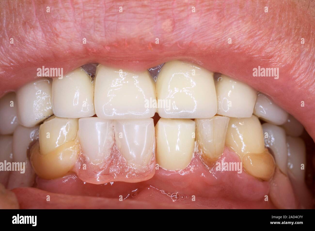Dentures and crown. A dental patient with dentures, and a crown on ...