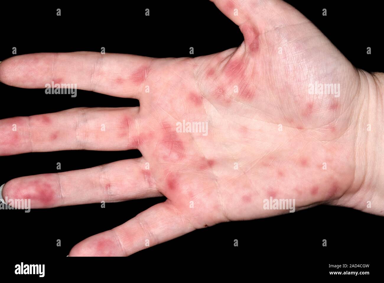 Rash in mycoplasma pneumonia. Close-up of a rash on the hand of a 29 ...