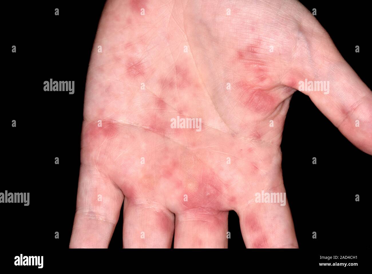Rash in mycoplasma pneumonia. Close-up of a rash on the hand of a 29 ...