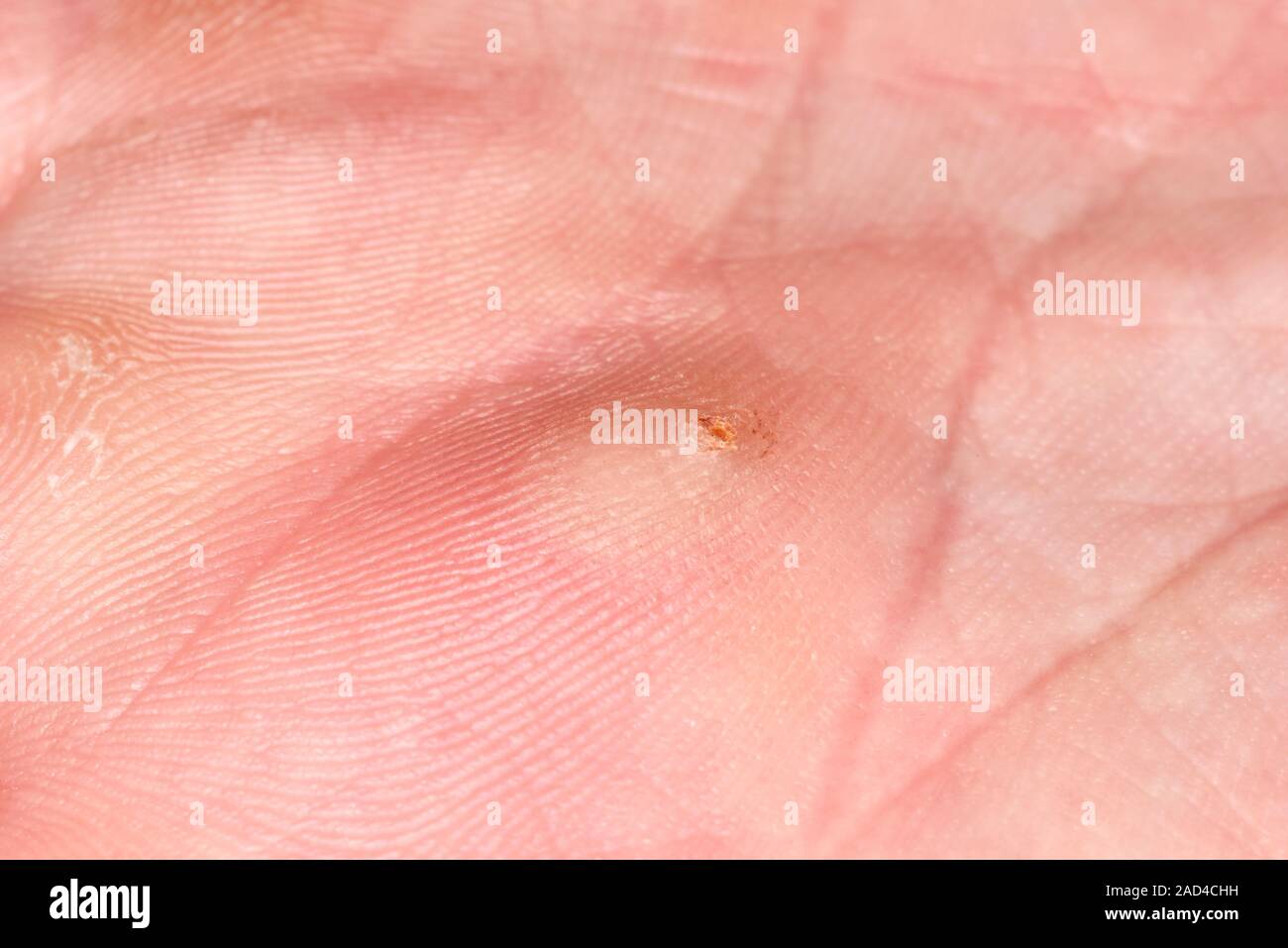 Hand abscess. Close-up of an abscess in the palm of an 39-year-old male ...