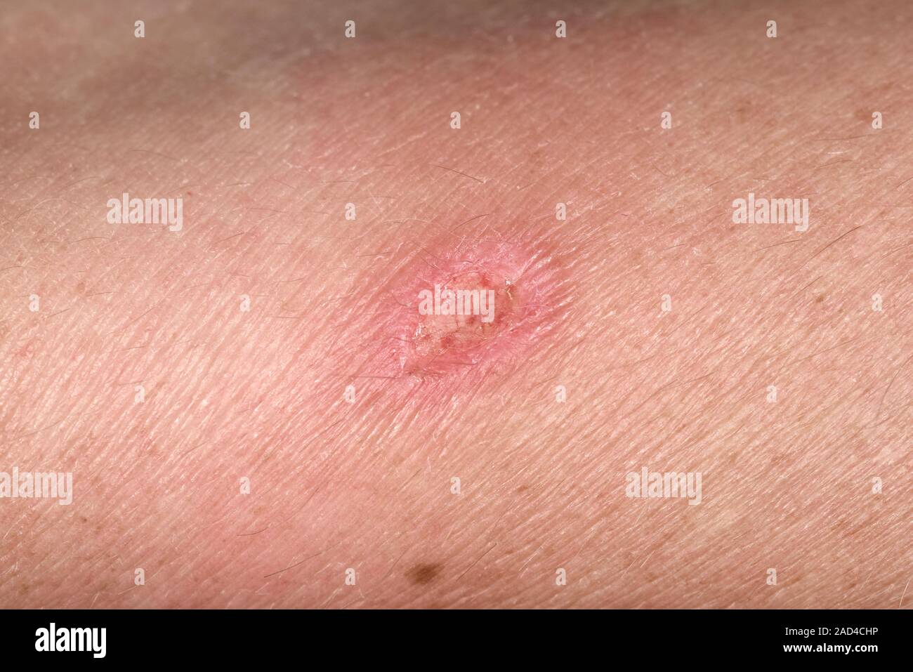 Infected spider bite. Close-up of an infected spider bite on the wrist ...