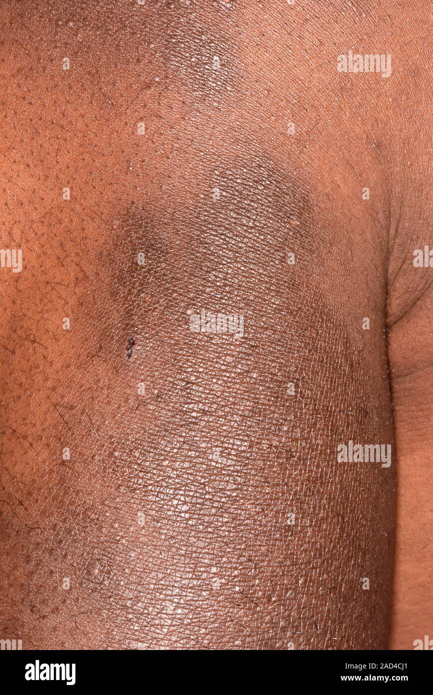 Post-inflammatory pigmentation in eczema. Close-up of post-inflammatory ...