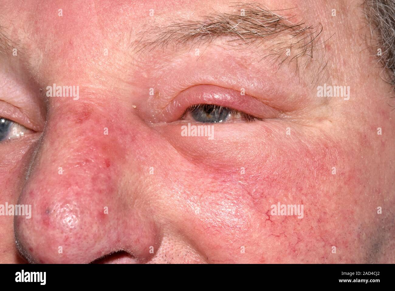 Swollen eye. Close-up of the swollen eye of an 81-year-old male patient ...