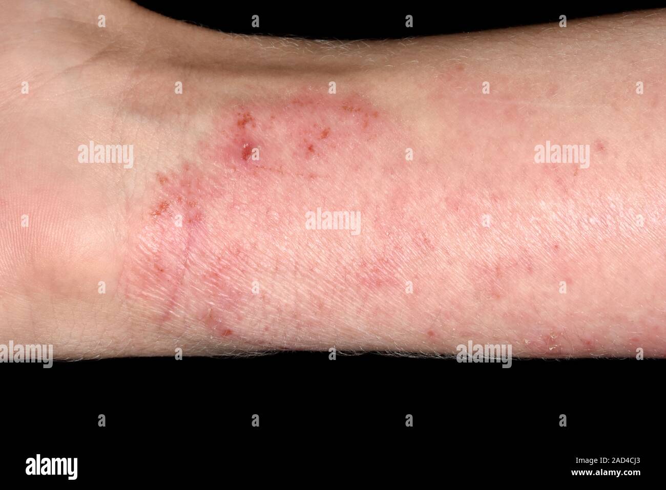 Eczema. Close-up of inflamed skin on the arm of a 16-year-old male ...
