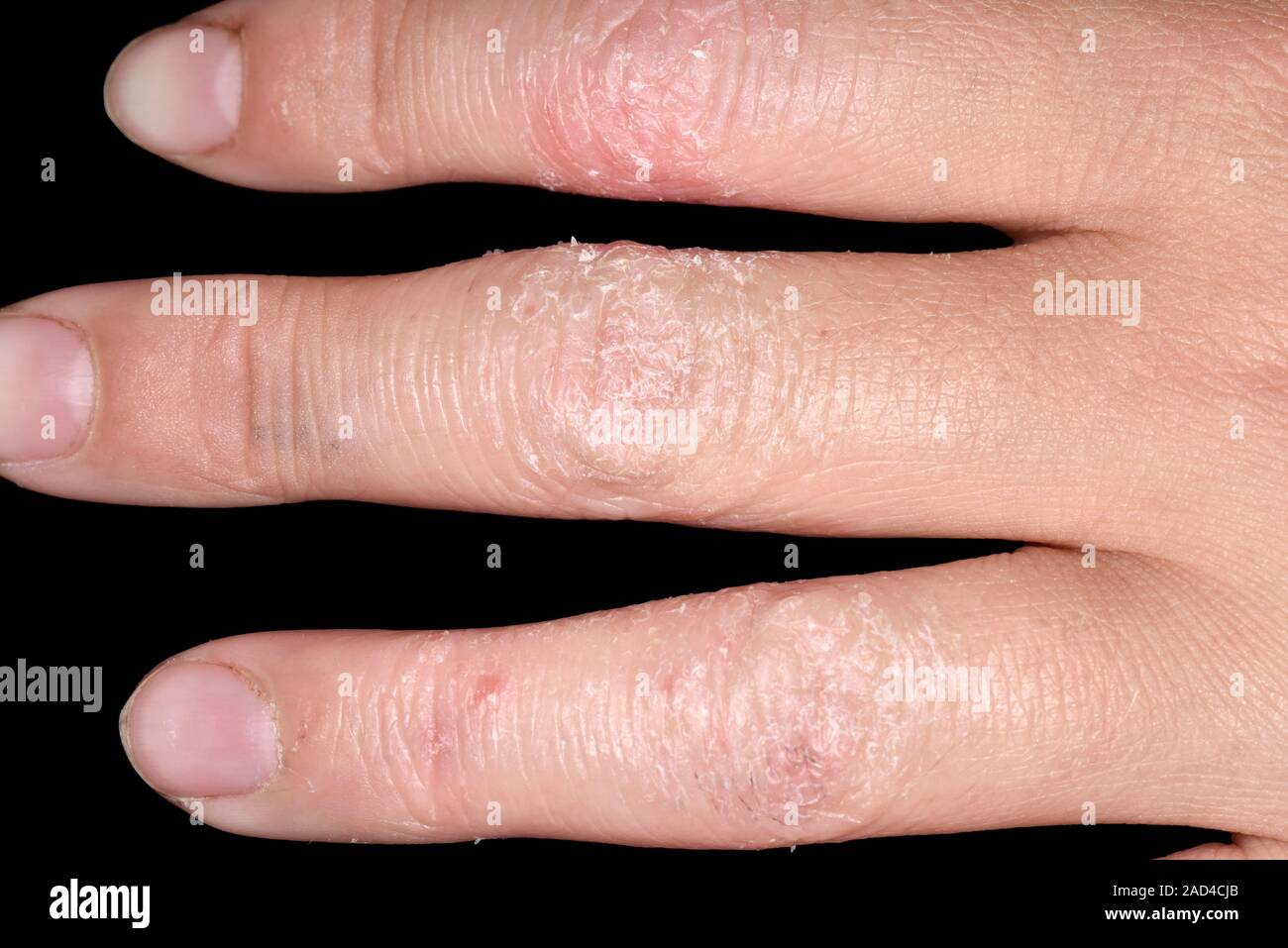 Eczema. Close up of inflamed skin on the finger of an 11 year old female with eczema. Eczema is an inflammation of the skin dermatitis accompanied b Stock Photo Alamy