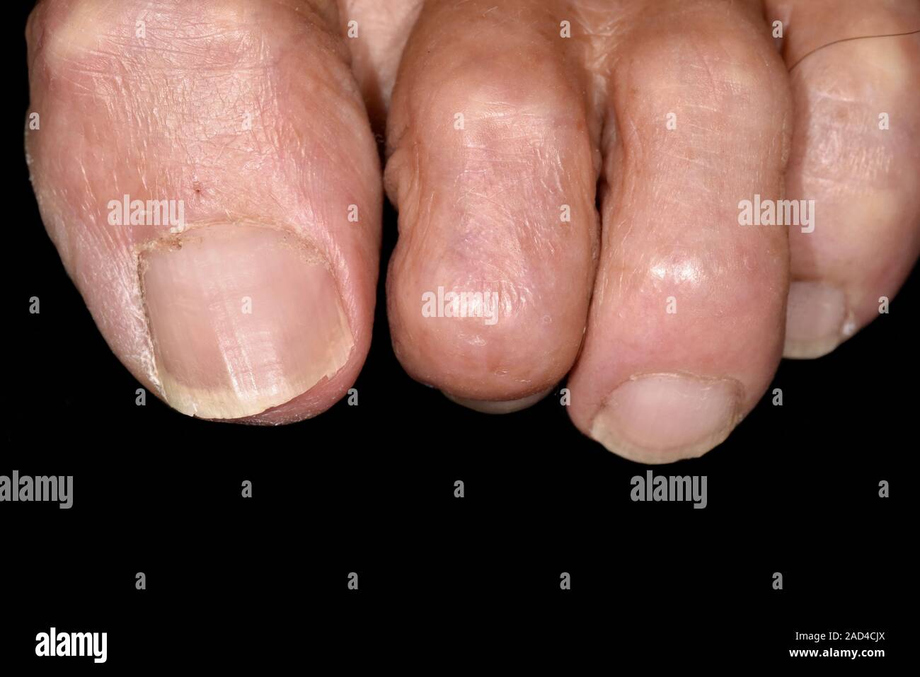 Congenital hammer toes. Close-up of the foot of a 73-year-old female ...