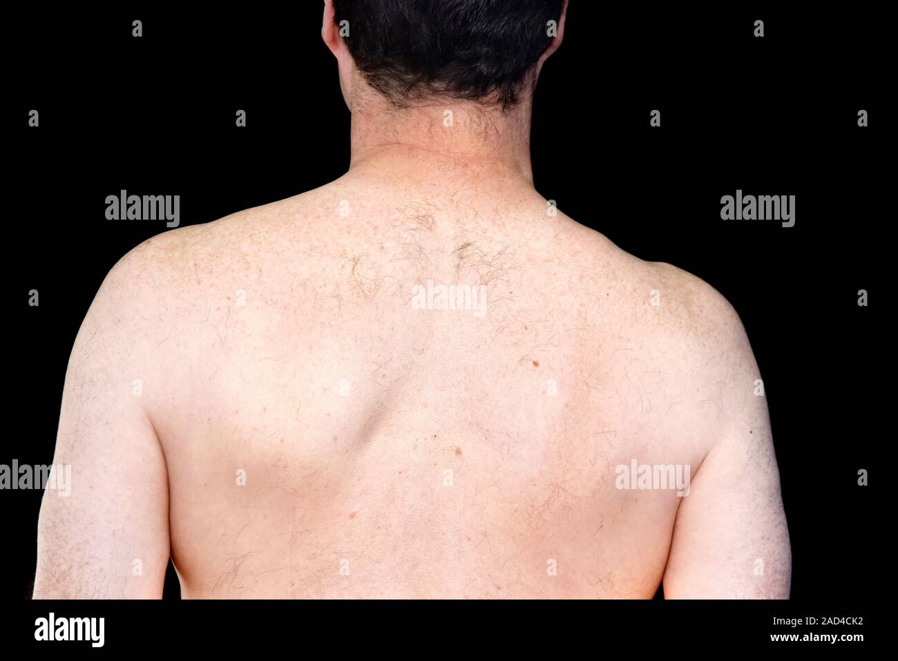 Muscle wasting in osteoarthritis. Close-up of the back of a 56-year-old ...