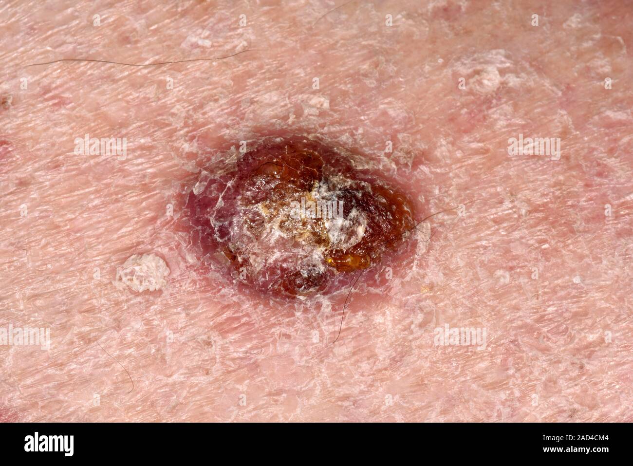 Skin cancer. Close-up of a large-cell lymphoma on the leg of an 83-year ...