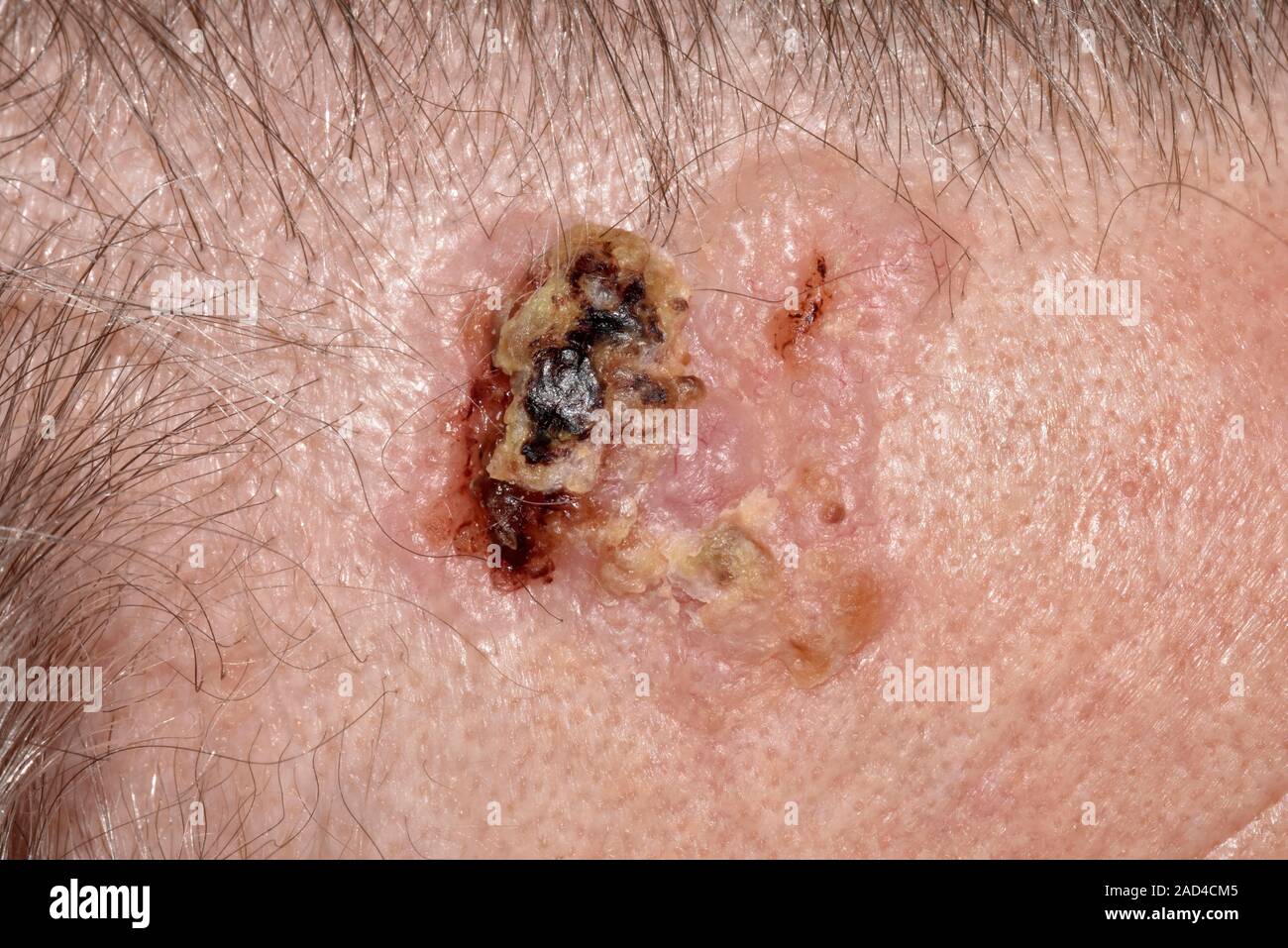 Basal Cell Carcinoma Skin Cancer Close Up Of A Basal Cell Carcinoma Bcc On The Forehead Of A