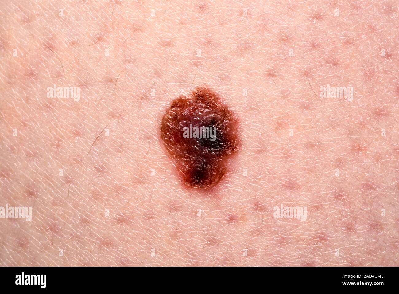 Basal-cell carcinoma skin cancer. Close-up of a superficial spreading ...