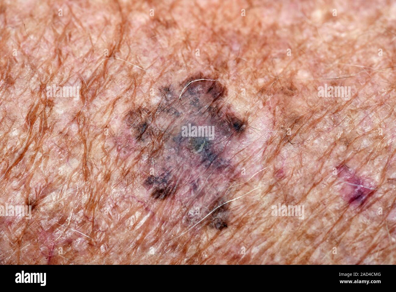 Basal-cell carcinoma skin cancer. Close-up of a malignant (cancerous ...