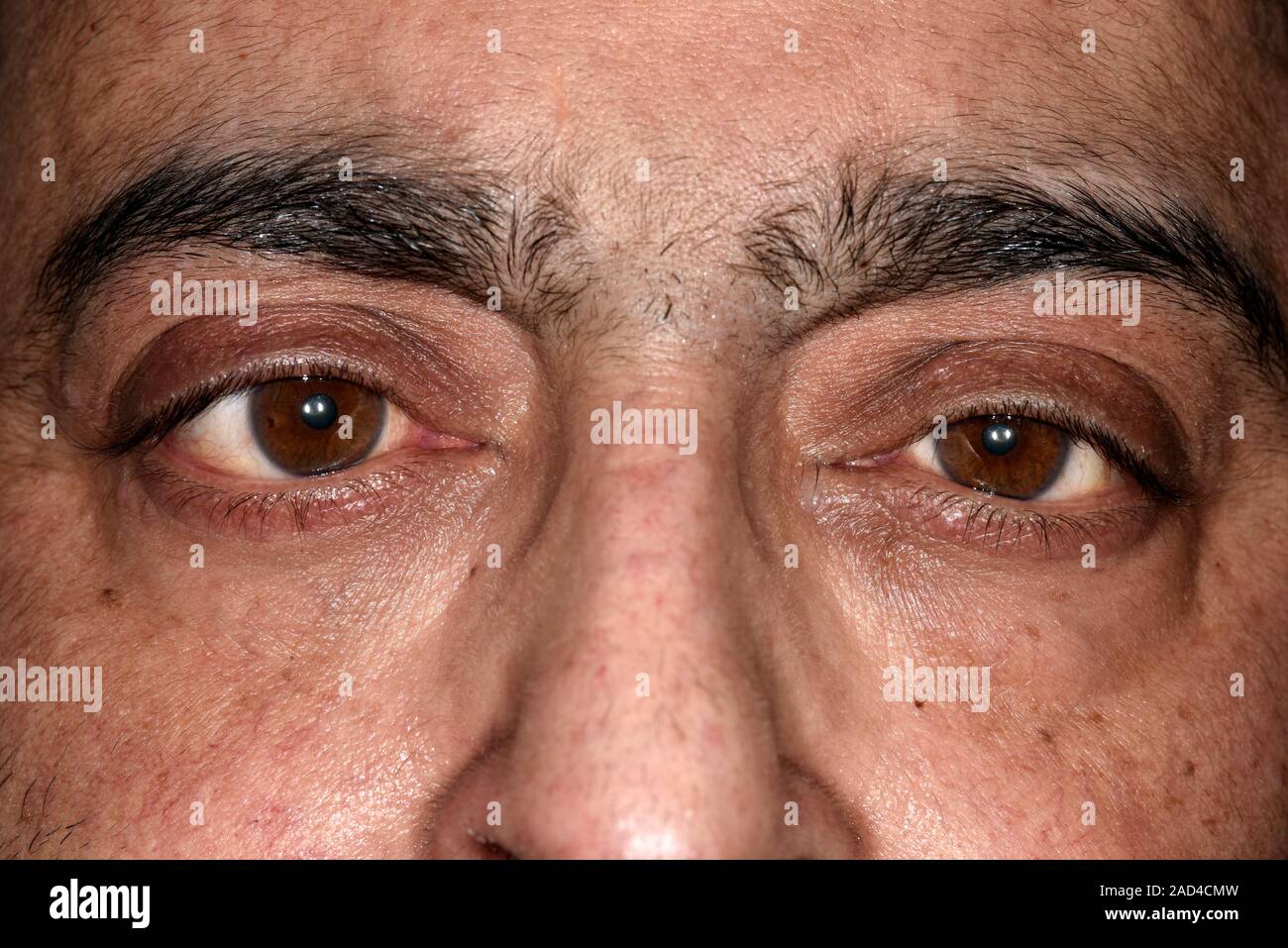 Eye squint in VI nerve palsy. Close-up of the squinting left eye (right ...