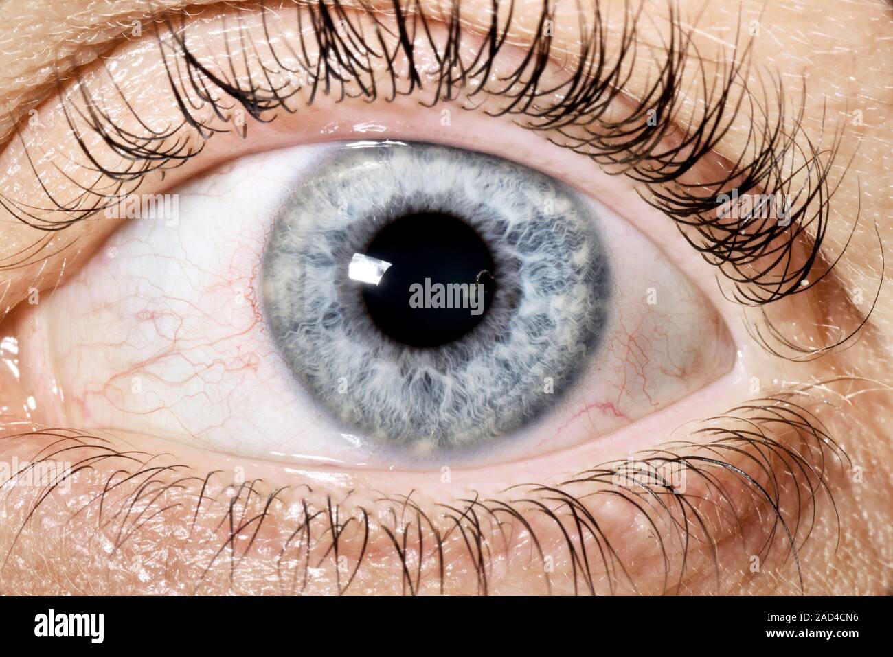 Foreign body in eye. Close-up of a foreign body on the cornea of the ...