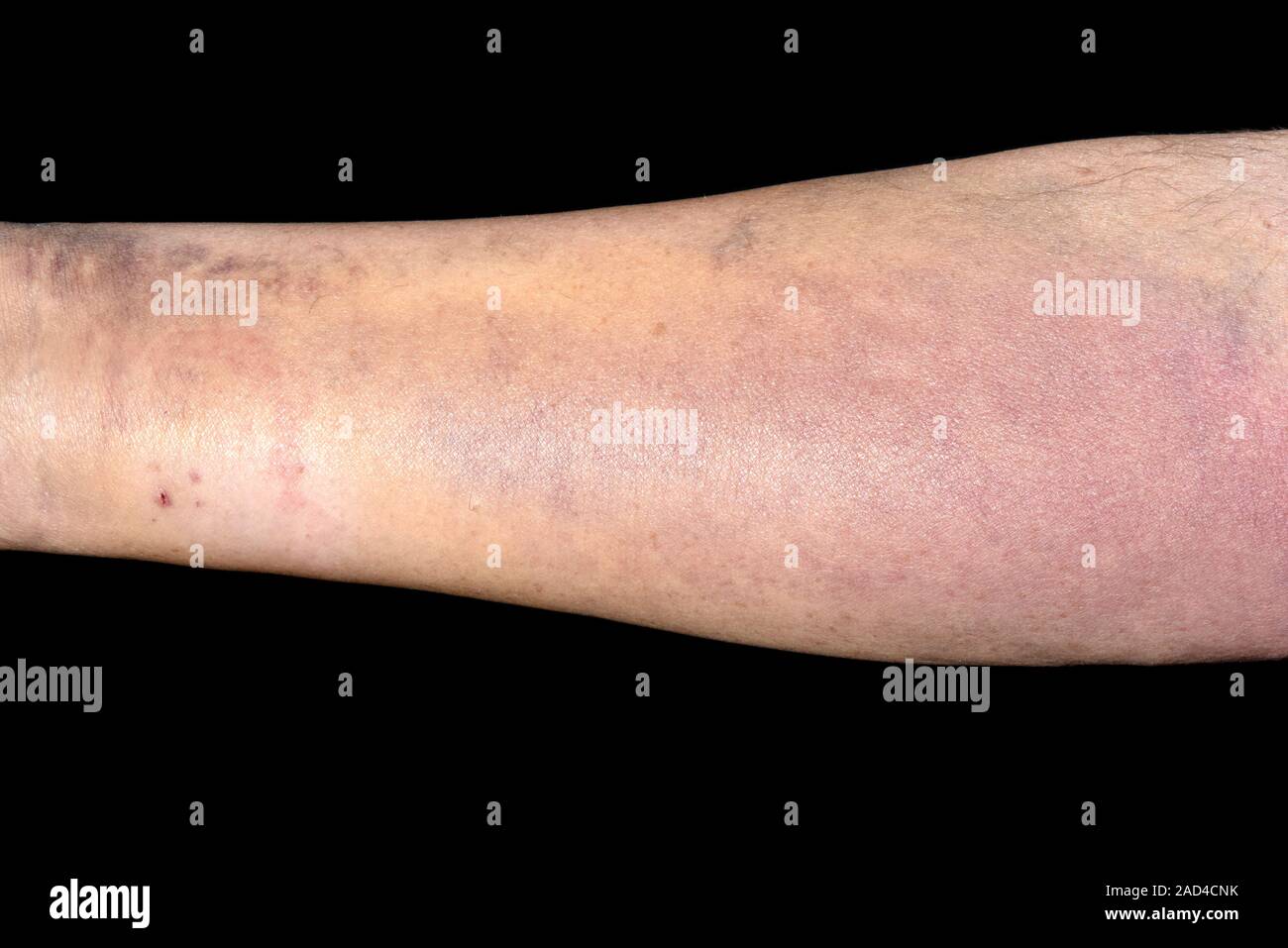 Bruising following angiogram. Close-up of bruising on the forearm of a ...