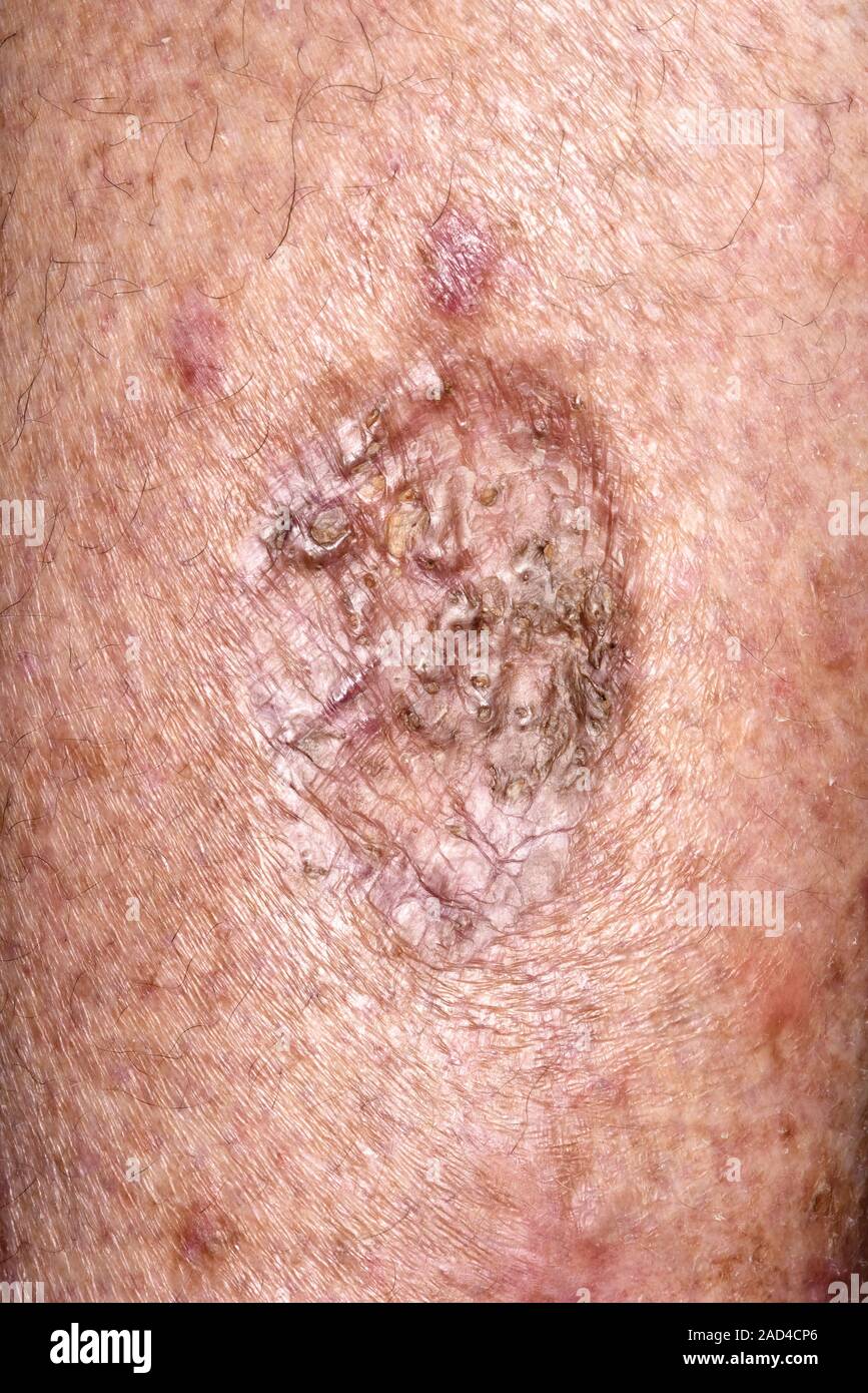 Scar after cancer removal. Close-up of a scar on the leg of an 83-year ...