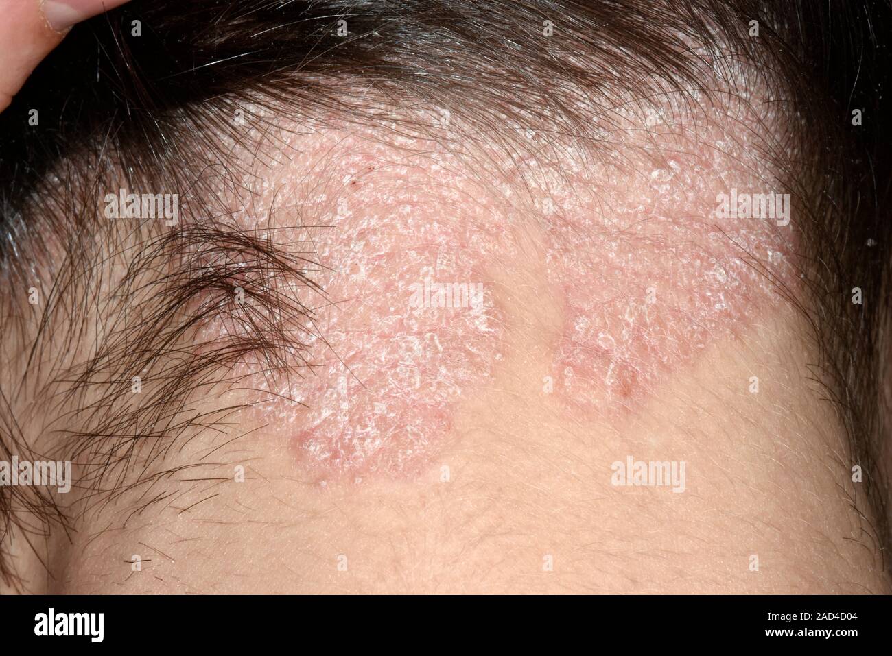 Psoriasis on the skin of the scalp of a 41 year old female patient ...