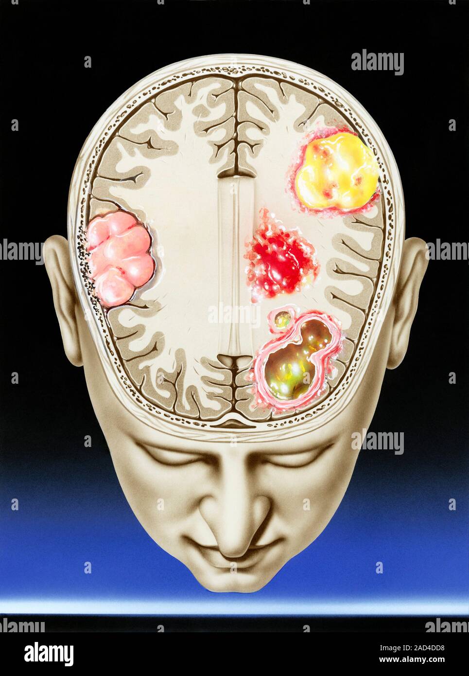 Causes of aphasia. Illustration of brain disorders and conditions that ...