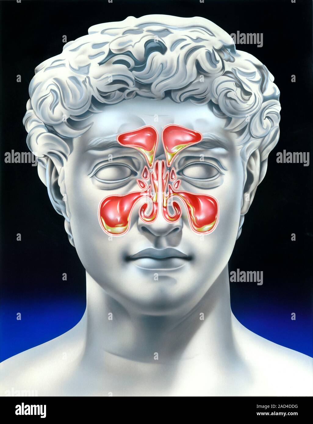 Sinusitis. Illustration of a frontal section through the nasal cavities ...