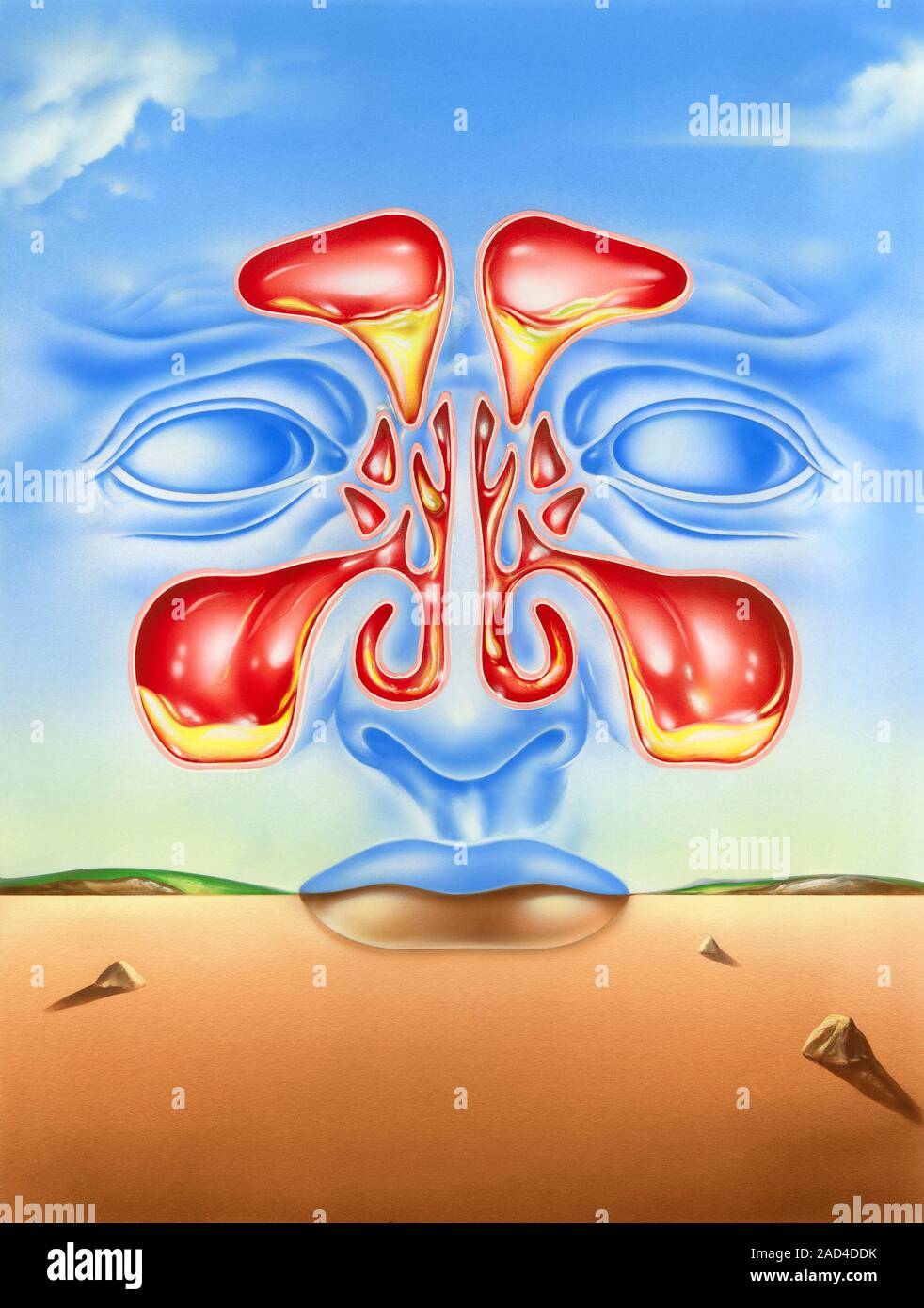 Sinusitis. Illustration of a frontal section through the nasal cavities ...