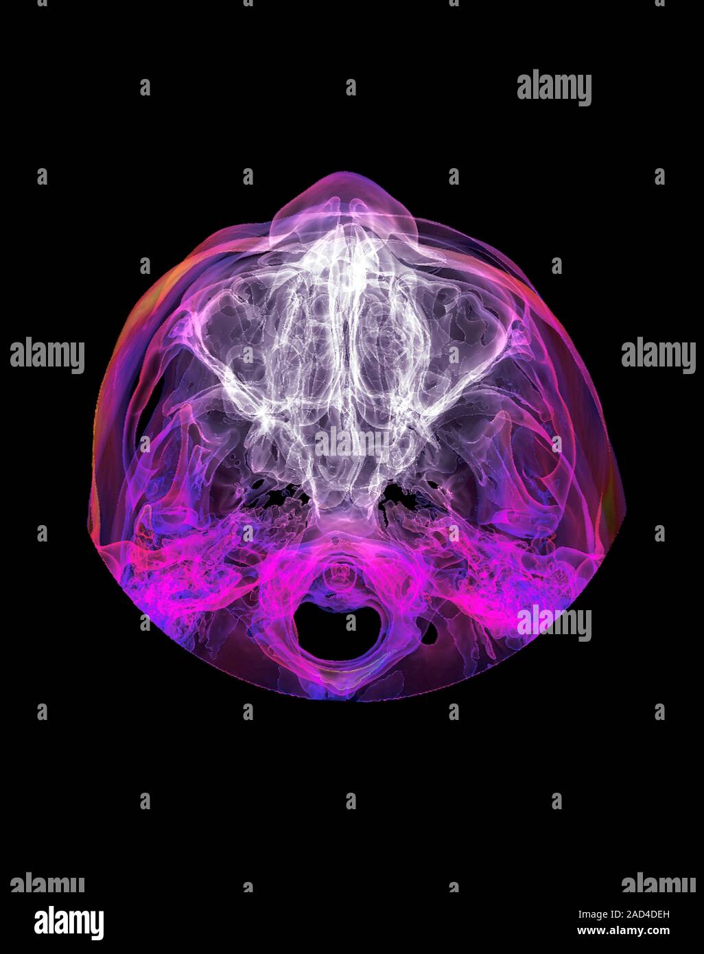 Normal facial bones and paranasal sinuses. Coloured 3D computed ...