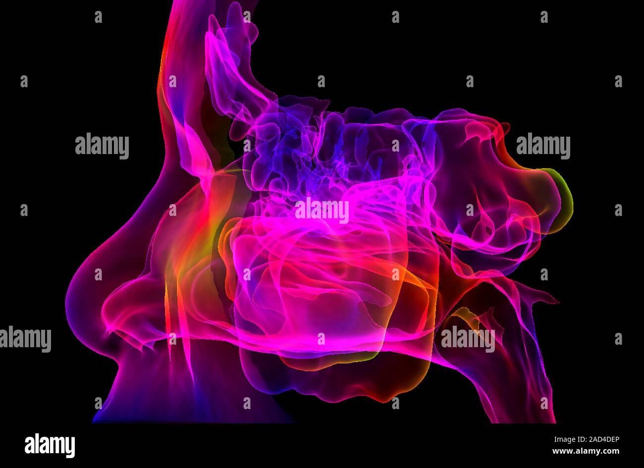 Normal facial bones and paranasal sinuses. Coloured 3D computed ...