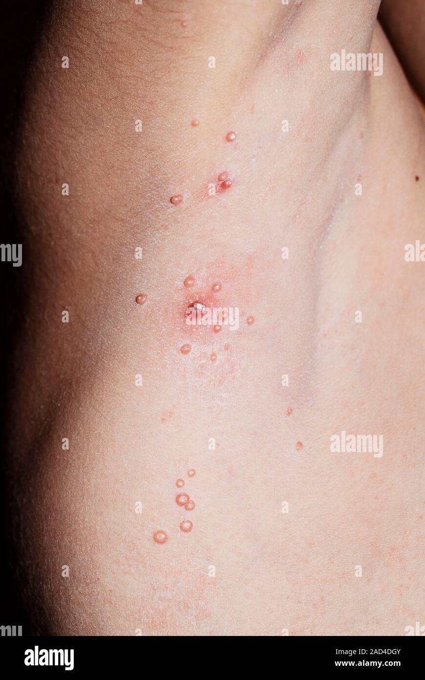 Molluscum contagiosum papules on the skin of an 11-year-old boy. This ...
