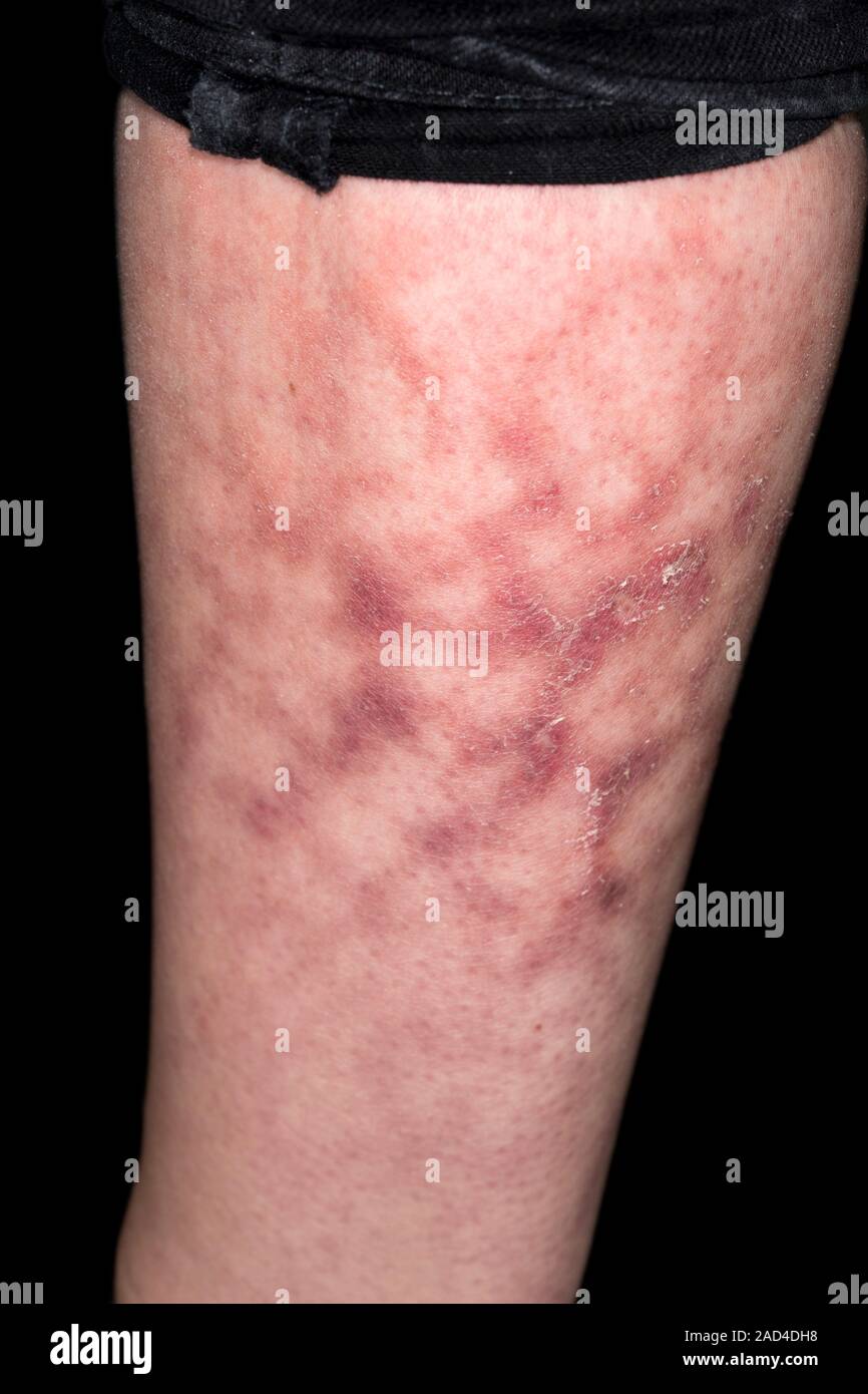 Reticulated erythema on a patient's lower leg. During cold seasons ...